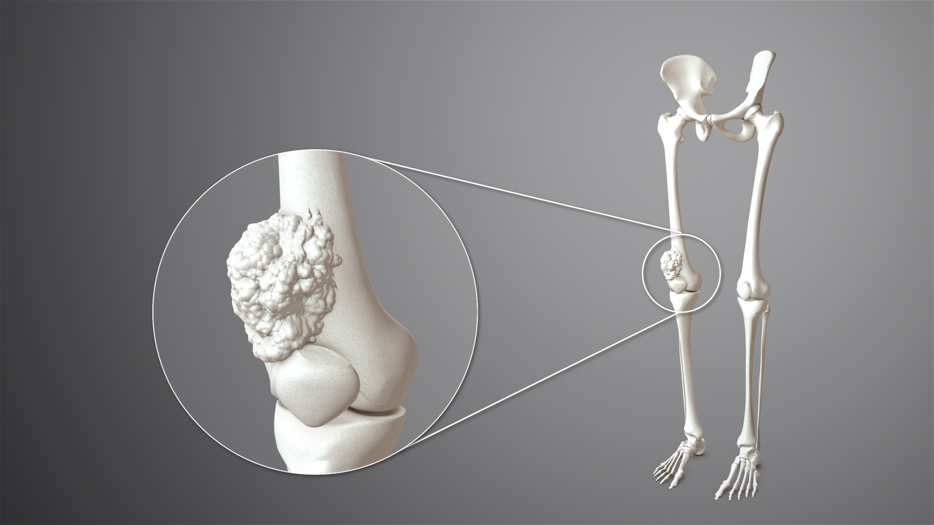 Bone Cancer Types Symptoms Causes And Treatment Scientific Animations Bone Cancer Types Symptoms Causes And Treatment Scientific Animations