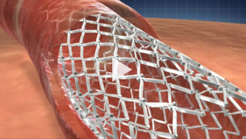 Vascular Access S2 - Stent - Scientific Animations