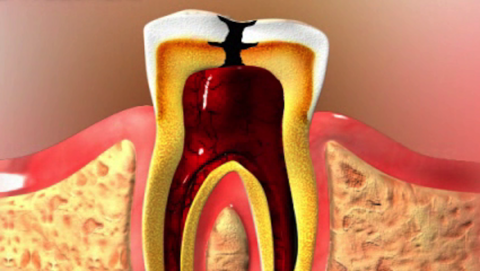 Treatment-infected pulp of the tooth-IQ21 - Scientific Animations