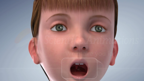 Tonsillectomy and Tonsillitis Explained via 3D Medical Animation