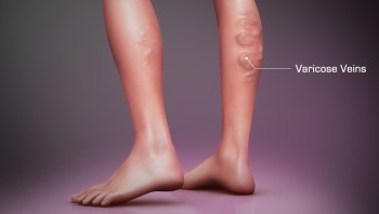 Zoomed in Varicose Veins - 3D Medical Illustration - Scientific Animations