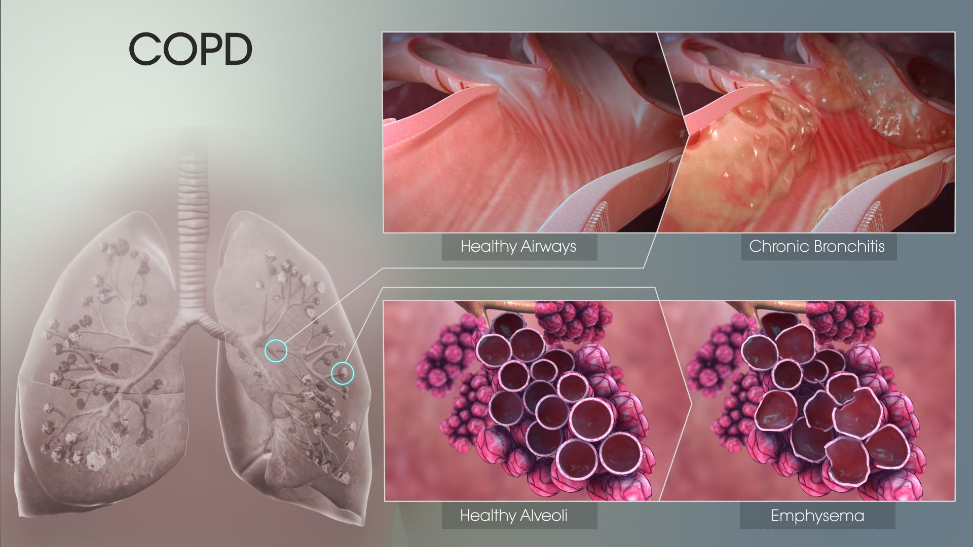 Why Does Our Immune System Fail To Fight COPD Scientific Animations