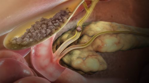 Gallstones can be removed non-surgically too - 3D Medical Animation