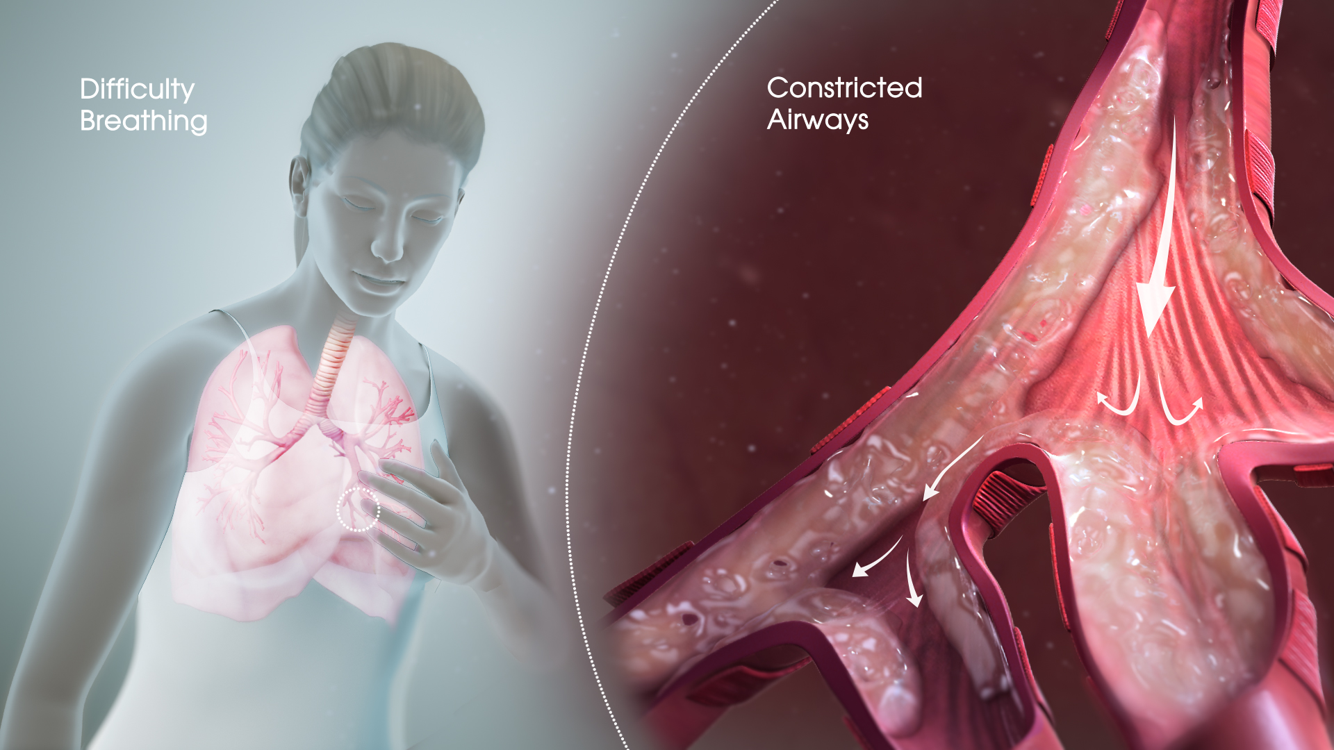 Asthma Types Causes Symptoms Treatment And Medication