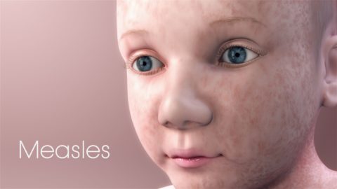 measles - Scientific Animations