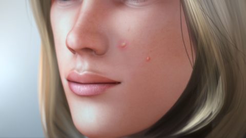 Pimples - Scientific Animations