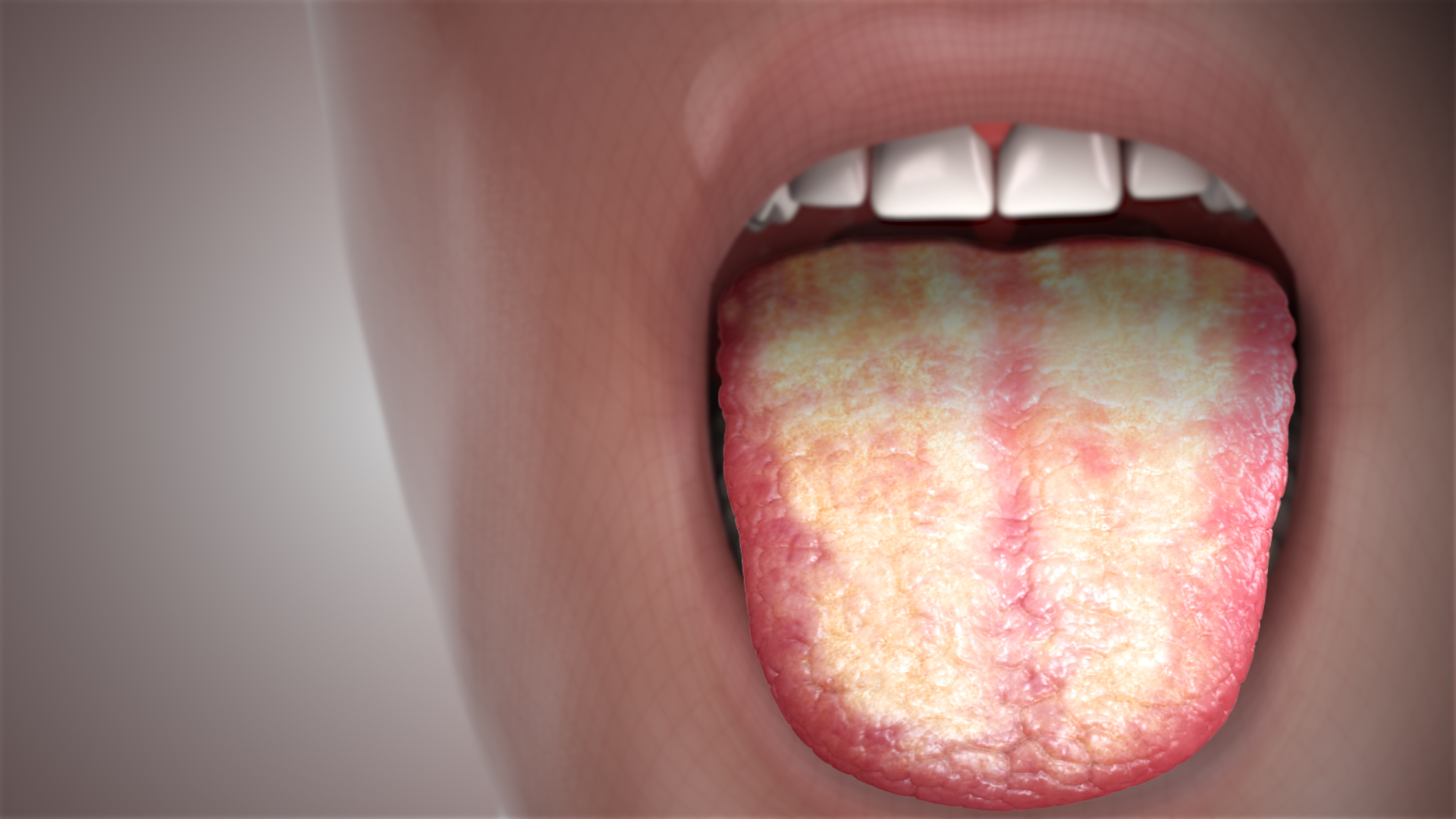 Candidiasis FI - Scientific Animations Candidiasis FI - Scientific Animations