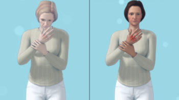 Rheumatoid Arthritis (RA)-Female - Scientific Animations