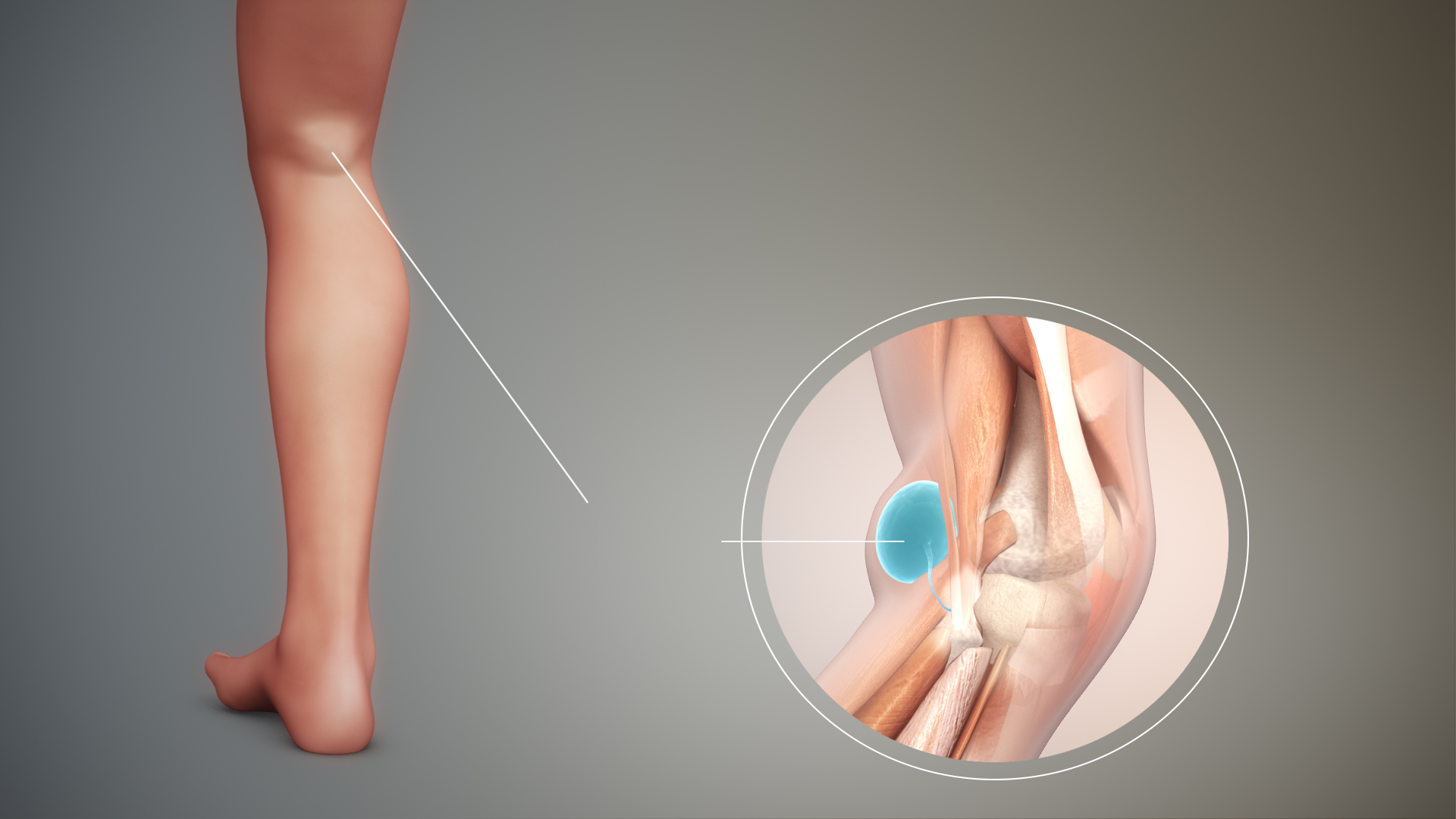Baker s Cyst Depicted Using A 3D Medical Animation And Described Briefly 
