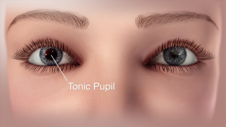 3D Medical Animation Showing Tonic Pupil Syndrome - Scientific Animations