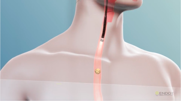 B29 Gastric Retrieval Device Showcase - Scientific Animations